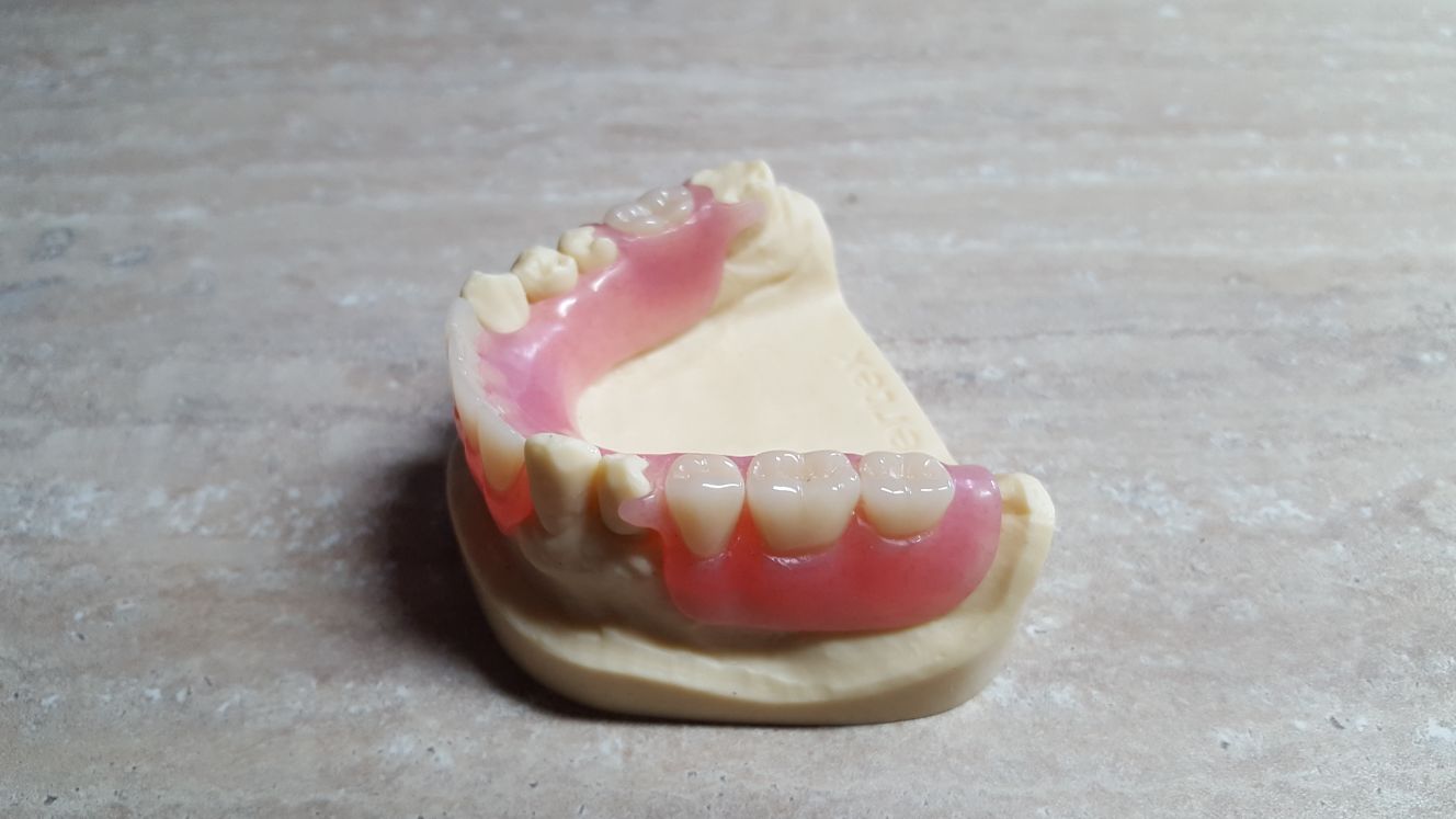 proteza koja se skida – Ordinacija dentalne medicine - Dubravka Matančević